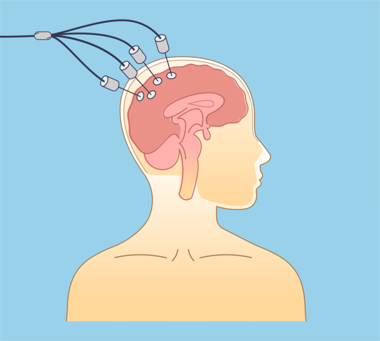 Advanced and More Invasive Assessments - ItsYourEpilepsy.com